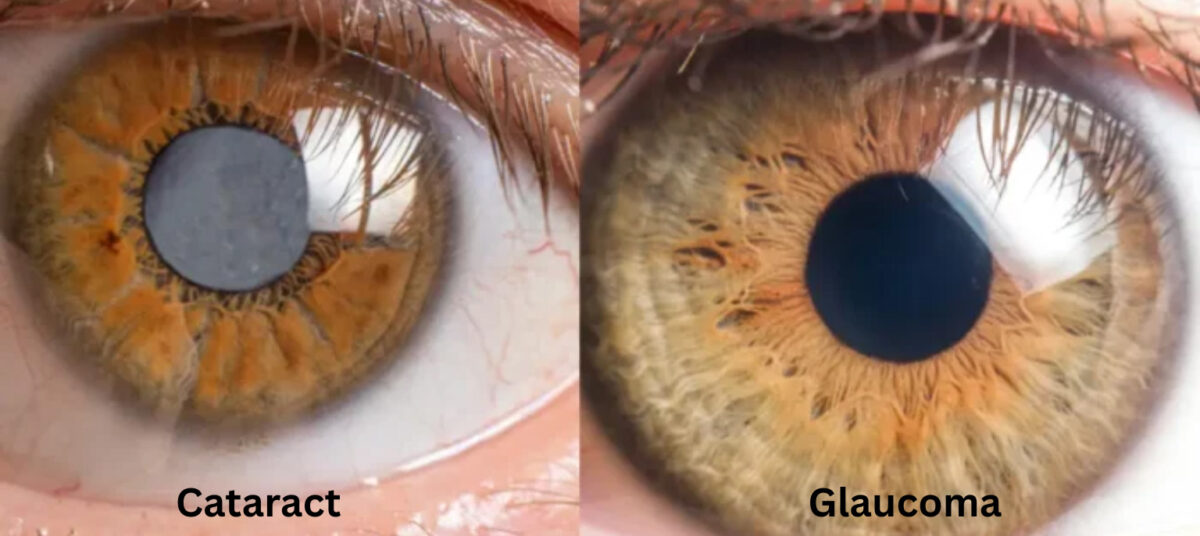 Protect Your Vision Against Glaucoma and Cataracts | Family Health Diary