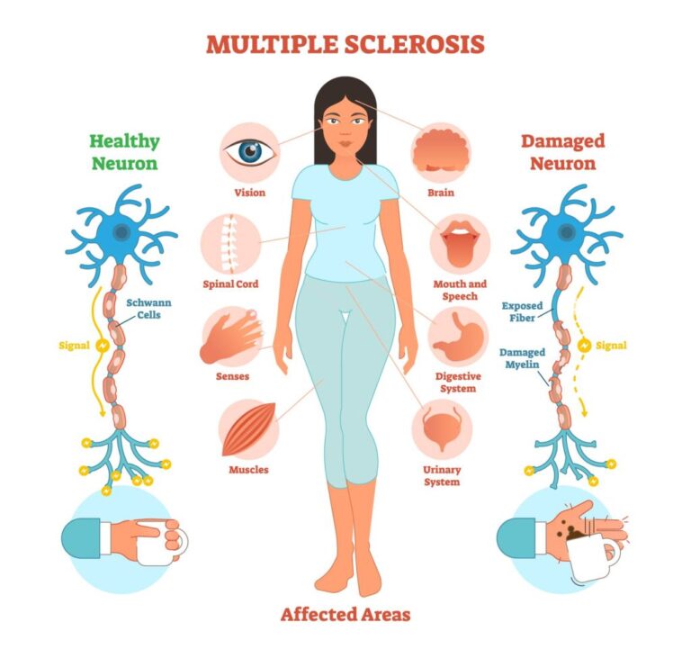 Multiple Sclerosis: A Closer Look at the Disease You Can’t Always See ...