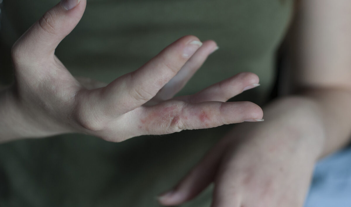 Scabies: What It Is, How It Spreads, and How to Stop It | Family Health ...