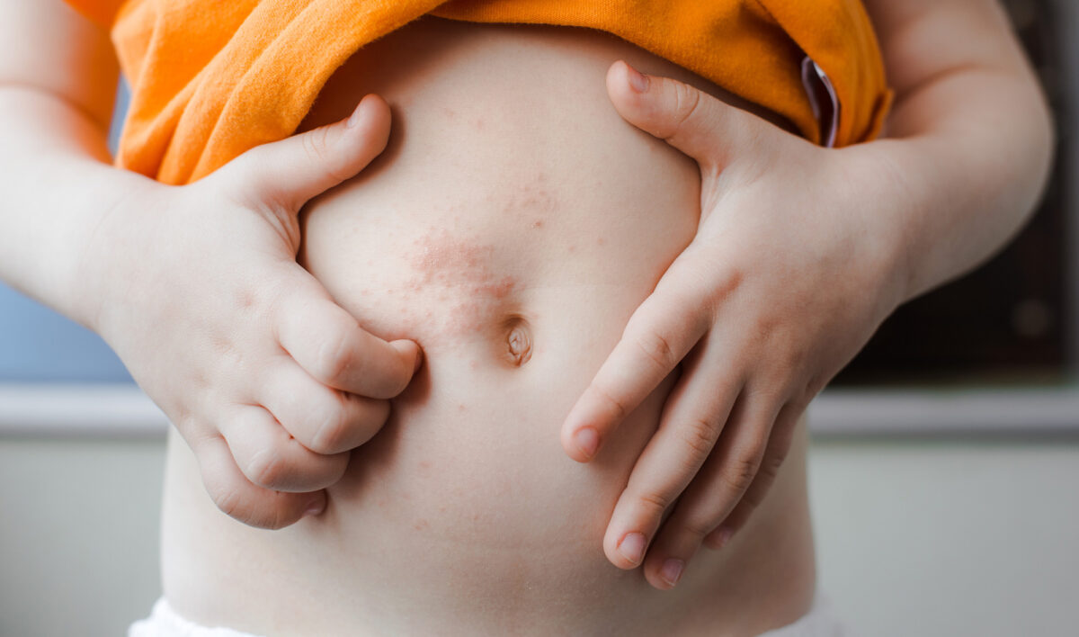 Scabies and bed bugs | Family Health Diary