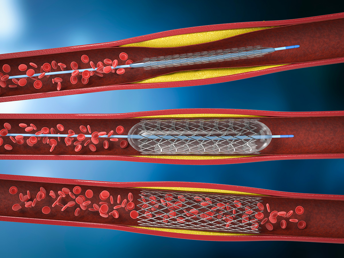 Your Guide to Stents and Angioplasty Procedures | Family Health Diary
